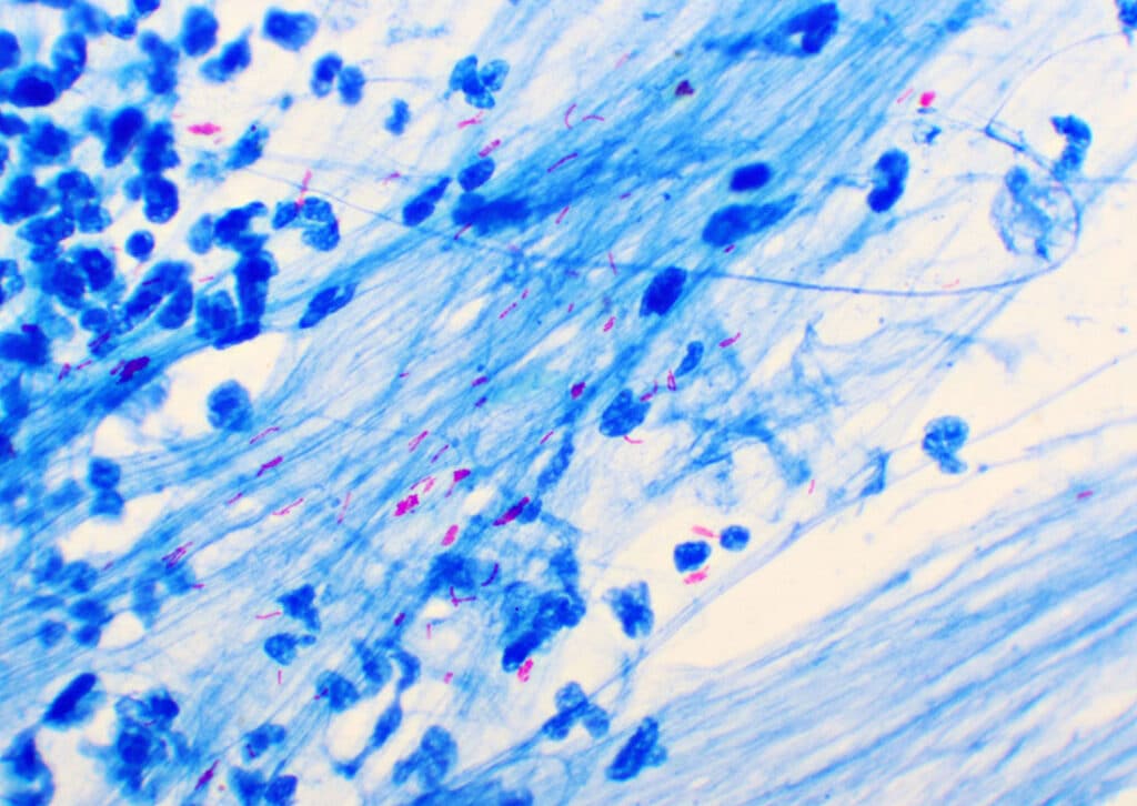 Human Sputum Samples | iSpecimen