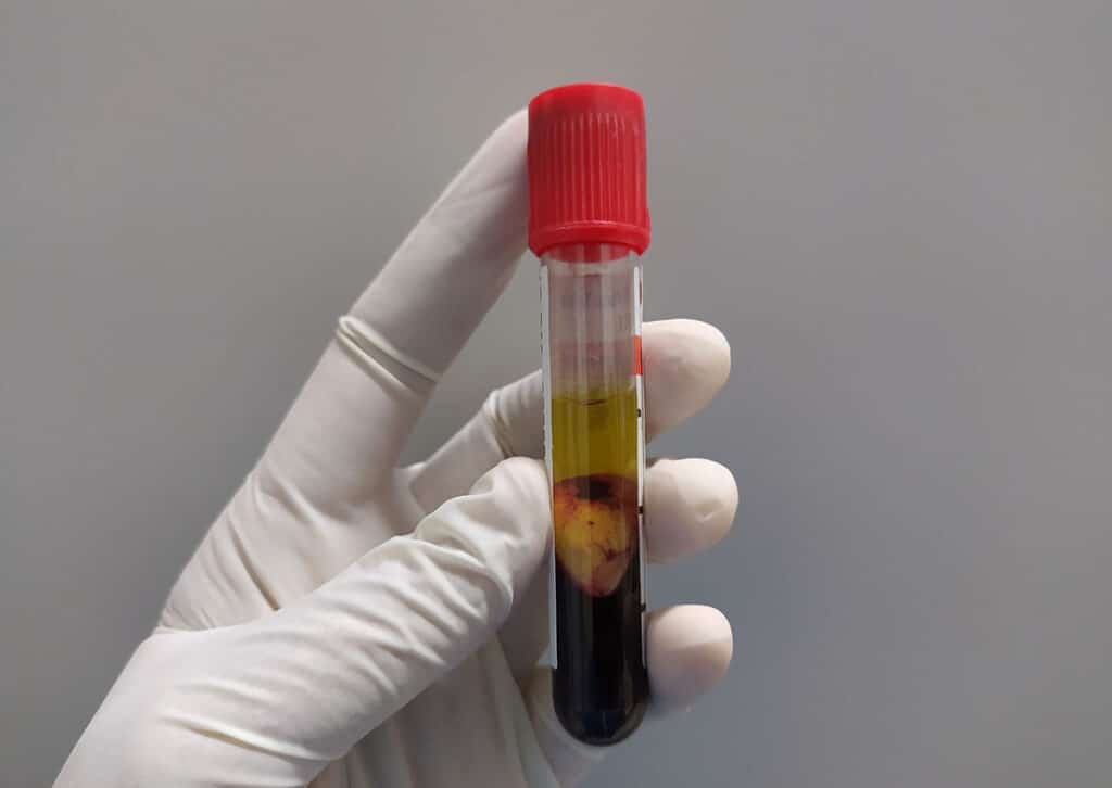 Human Serum & Plasma Samples | iSpecimen